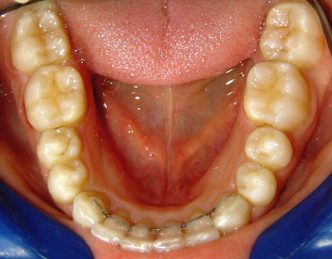 12-Foto final arcada superior | Dentistas Estetica dental - Ortodoncia ...
