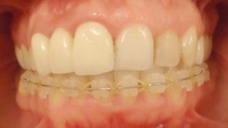 Clinical cases of orthodoncy | Dentistas Estetica dental - Ortodoncia Salud