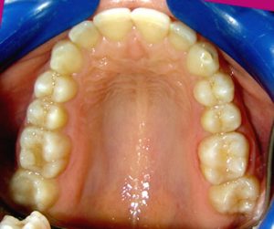 12-Foto final arcada superior | Dentistas Estetica dental - Ortodoncia ...