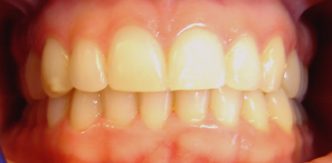 12-Foto final arcada superior | Dentistas Estetica dental - Ortodoncia ...