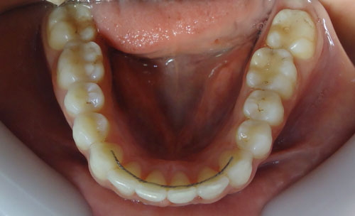 25- Arcada inferior finalizada con contención fija – Dentistas Estetica ...