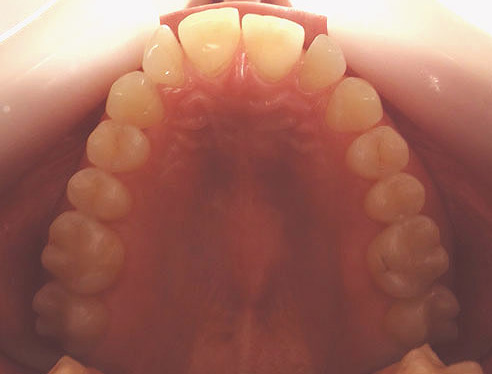 4-Vista-oclusal-de-arcada-superior-malposición-sector-incisivos ...