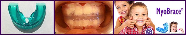 ¿Cómo funciona el Sistema Trainer y Myobrace? | Dentistas Estetica ...